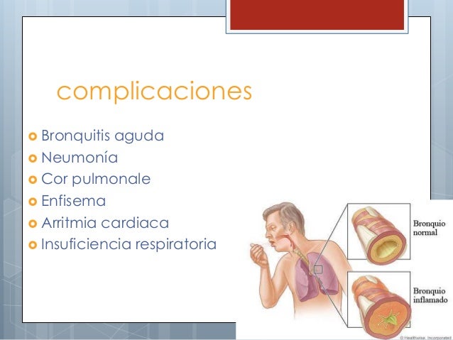 Bronquitis aguda