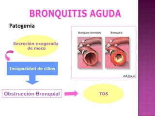 Bronquitis aguda | PPTX