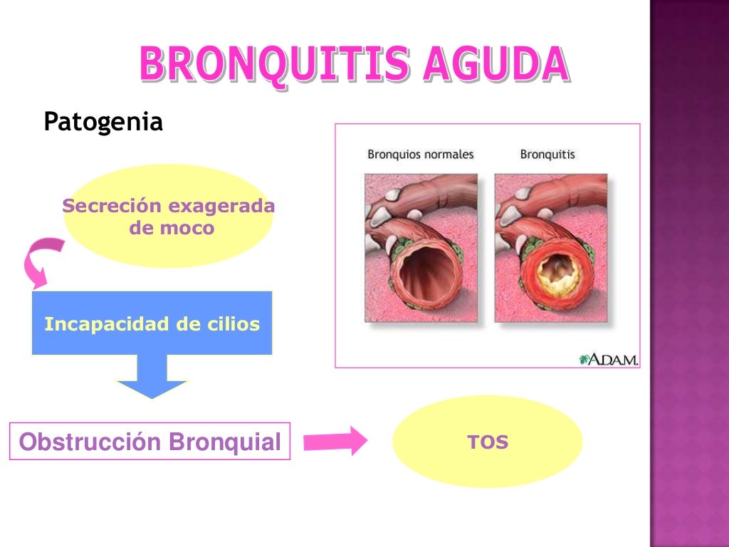Bronquitis aguda