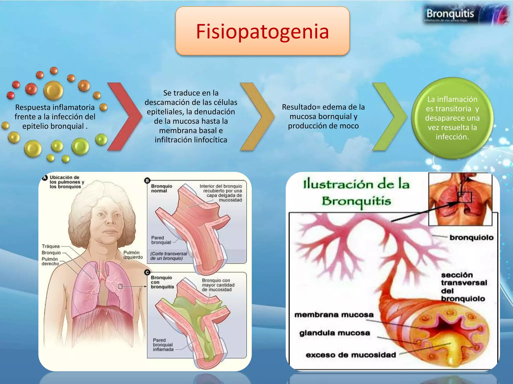 Bronquitis aguda | PPTX