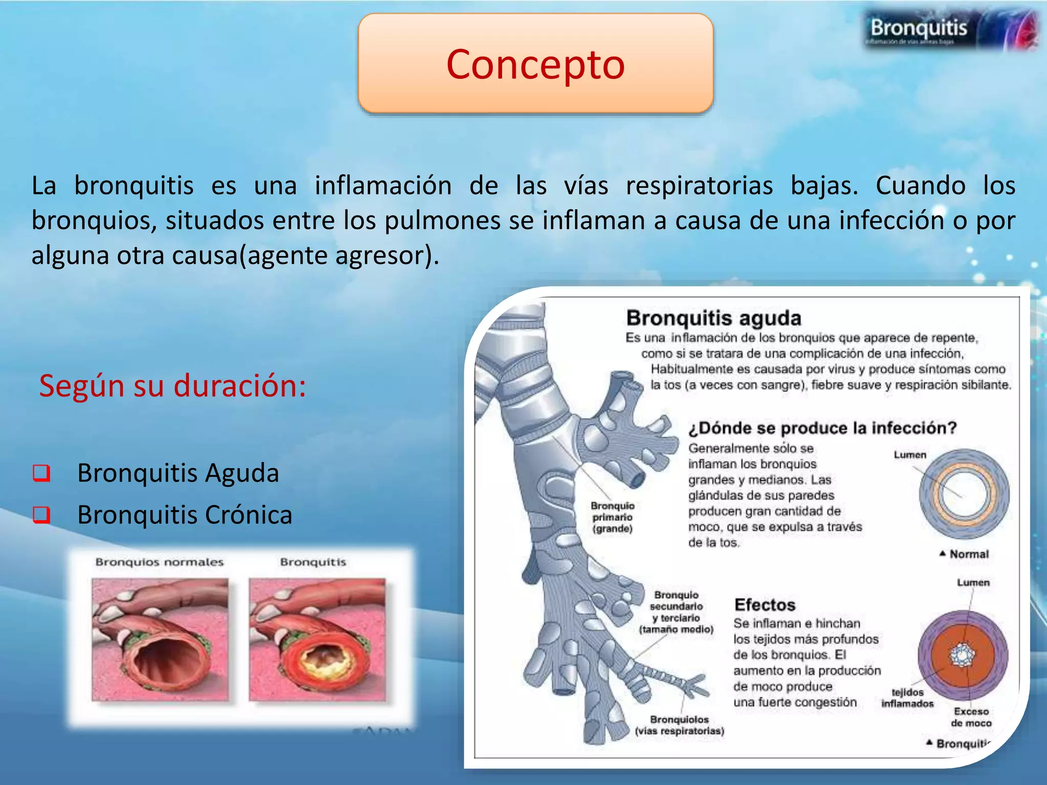 Bronquitis aguda | PPTX