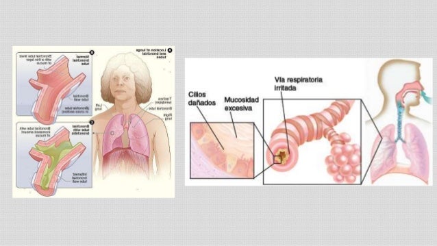 BRONQUITIS - Mind Map