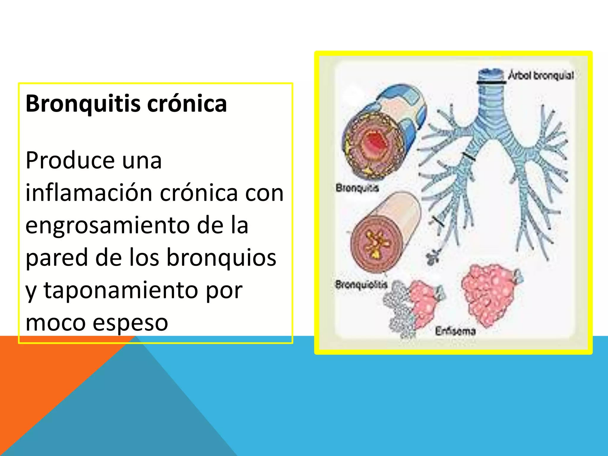 Bronquitis cronica | PPTX | Lung and Respiratory Health | Diseases and ...
