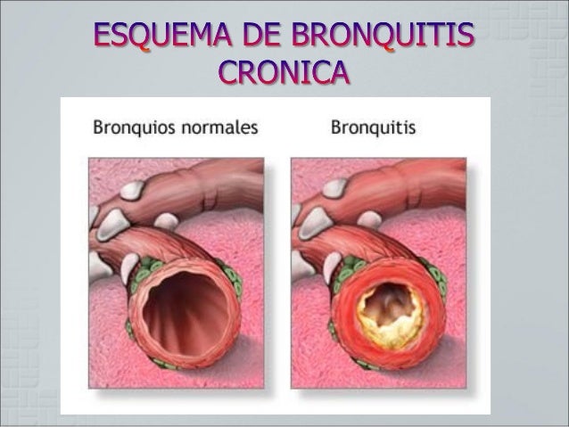 Bronquitis cronica