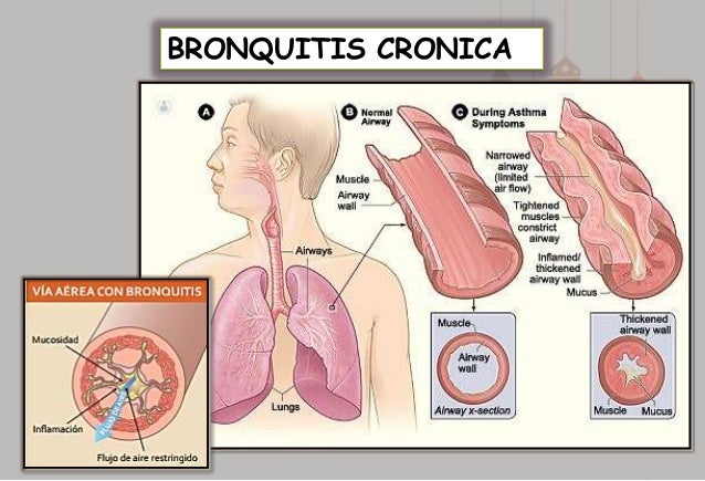 BRONQUITIS CRONICA