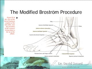 BroströM Procedure Presentation | PPT
