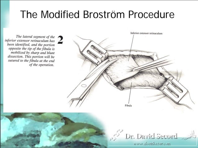 BroströM Procedure Presentation