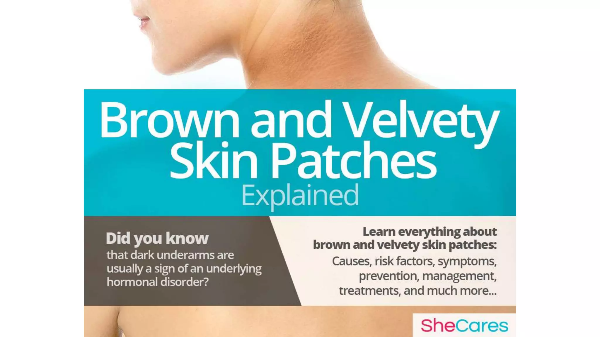 Brown and velvety skin patches infographics - SheCares | PPTX