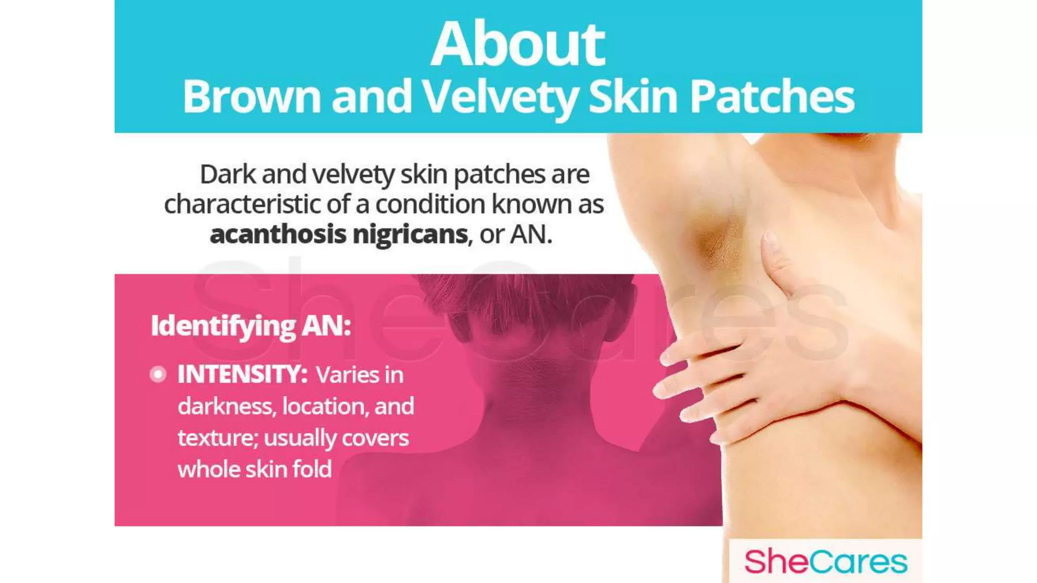 Brown and velvety skin patches infographics - SheCares | PPTX