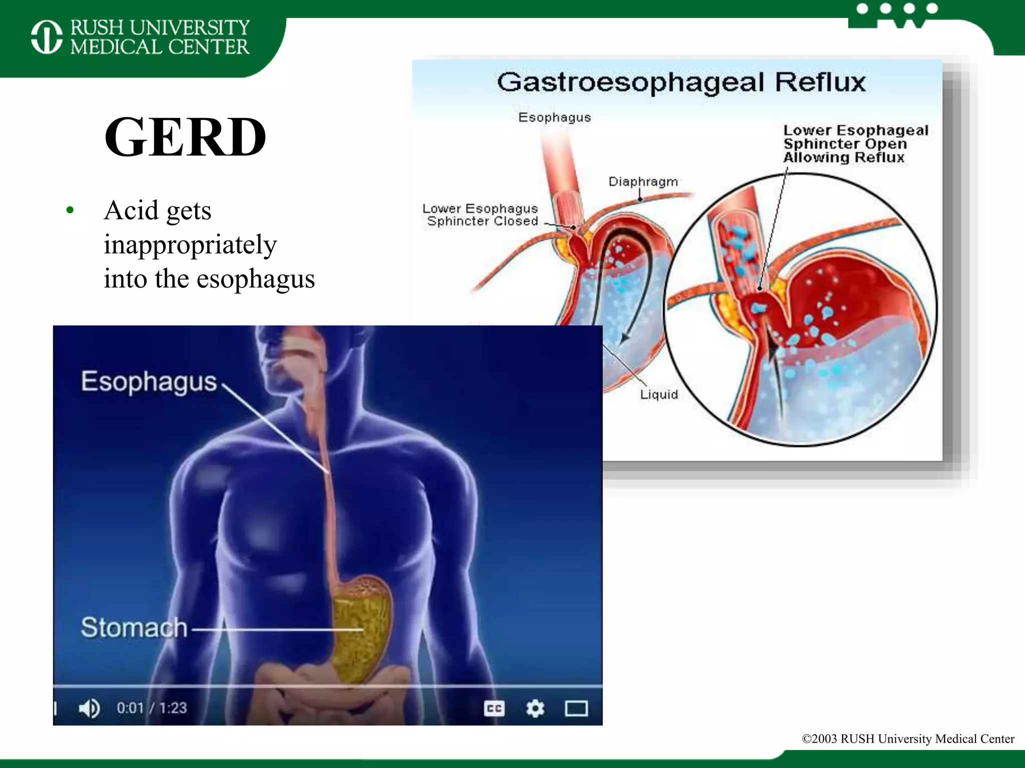 Scleroderma and the GI Tract | PPTX