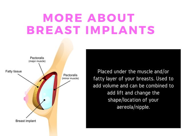 What Are My Breast Augmentation Options? | PDF | Cosmetic Medical Services | Medical Health