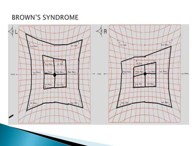 Brown's syndrome | PPTX | Eye and Vision Conditions | Diseases and ...