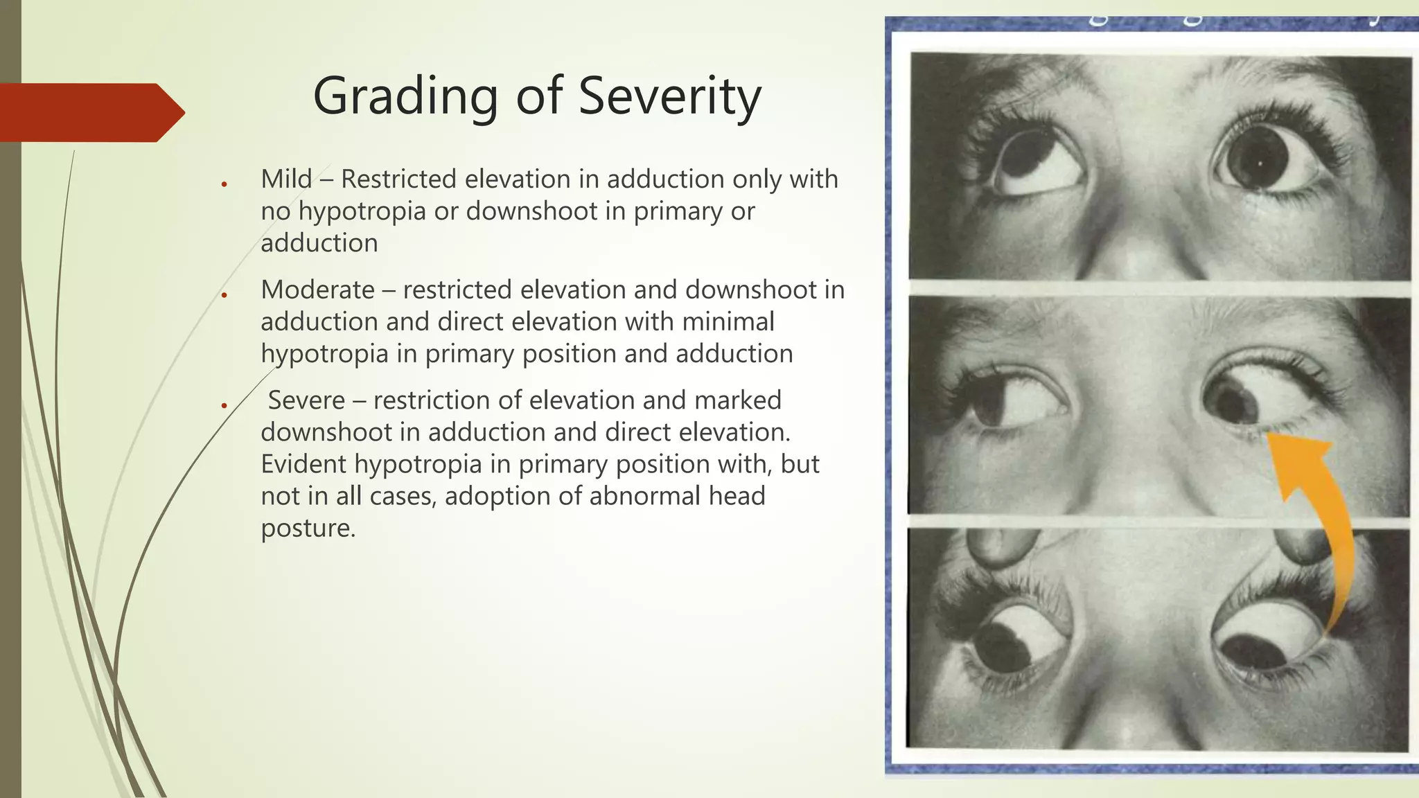 Brown syndrome | PPTX