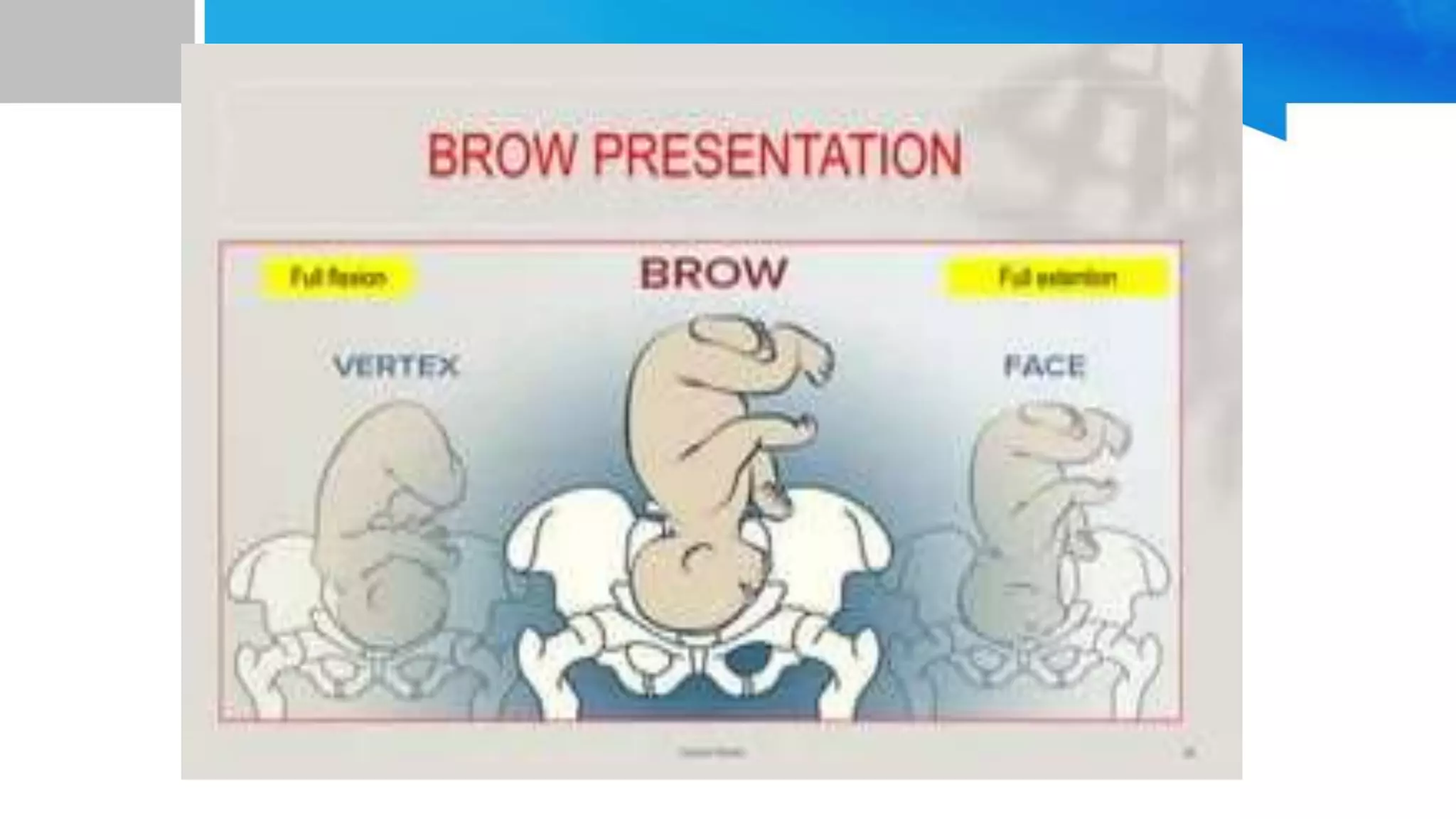 Brow presentation.pptx