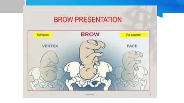Brow presentation.pptx