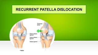 SAF_RECURRENT PATELLA DISLOCATION (1).pptx