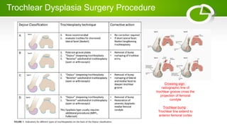 SAF_RECURRENT PATELLA DISLOCATION (1).pptx