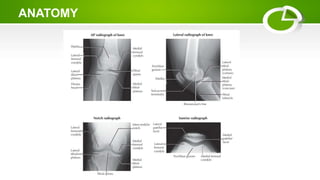 Saf Recurrent Patella Dislocation 1 Pptx