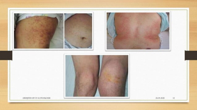 Brucella and brucellosis | PPTX | Infectious Diseases | Diseases and ...