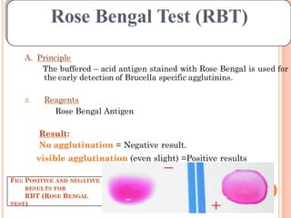 brucellosis and clinical features , .pdf