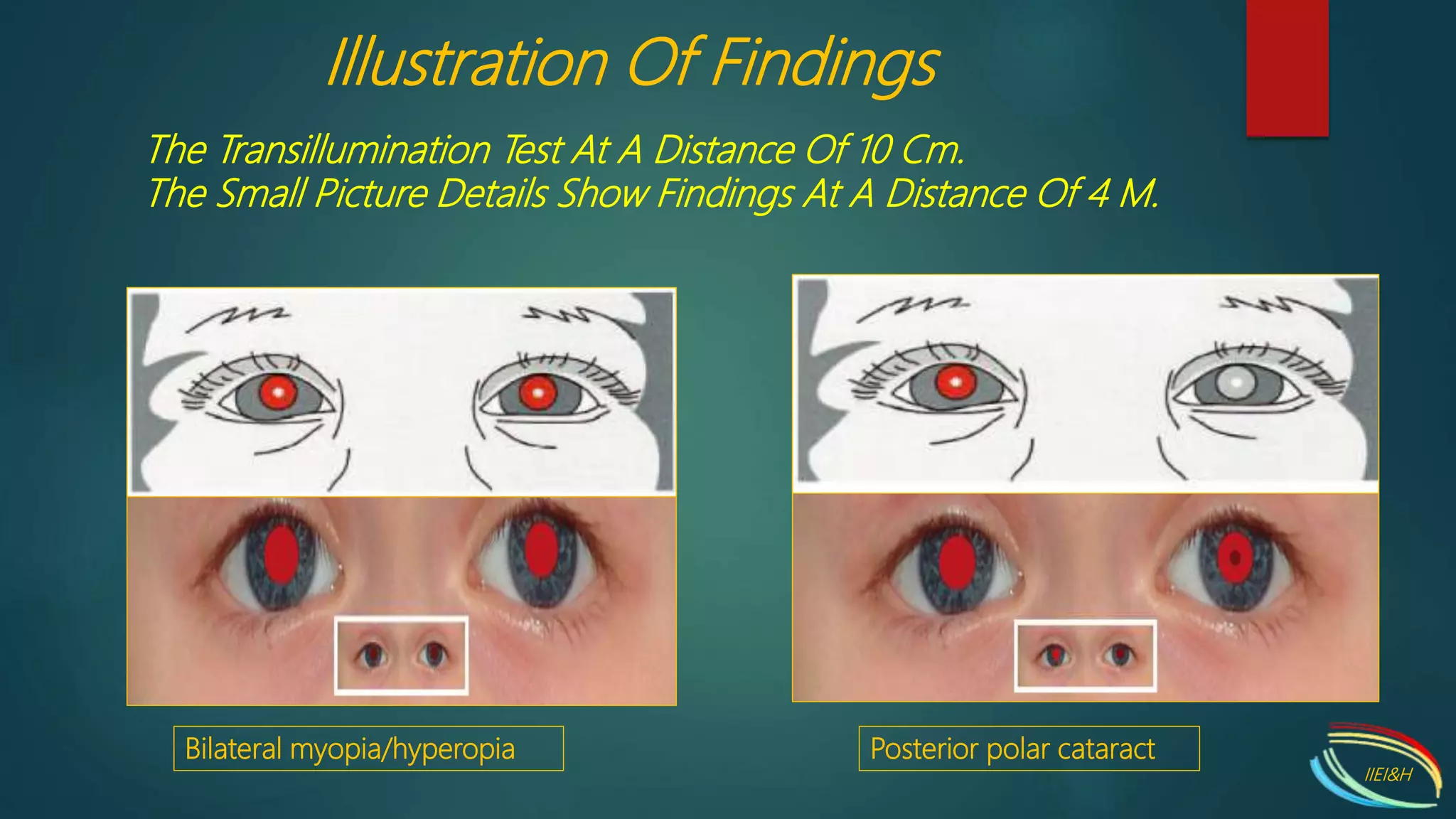 Bruckner test | PPTX