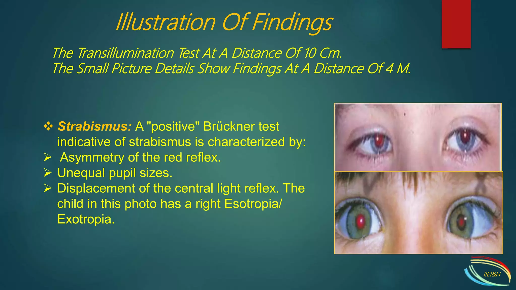 Bruckner test | PPTX