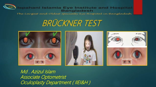 Bruckner test | PPTX | Eye and Vision Conditions | Diseases and Conditions