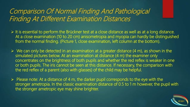 Bruckner test | PPTX | Eye and Vision Conditions | Diseases and Conditions