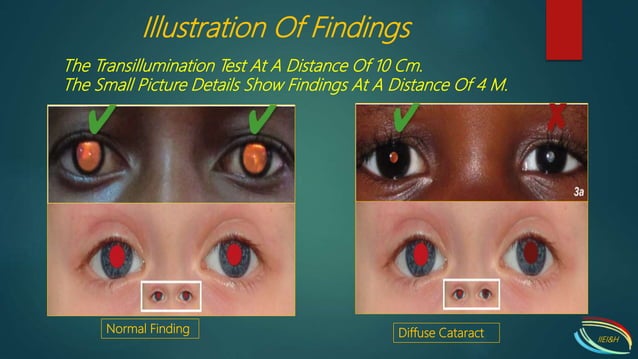Bruckner test | PPTX | Eye and Vision Conditions | Diseases and Conditions