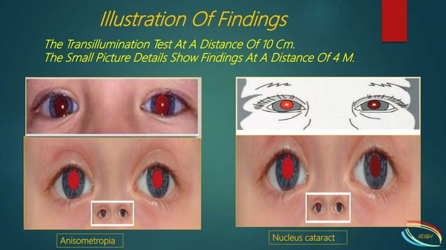 Bruckner test | PPTX | Eye and Vision Conditions | Diseases and Conditions