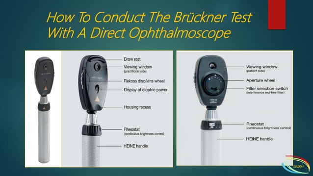 Bruckner test | PPTX | Eye and Vision Conditions | Diseases and Conditions