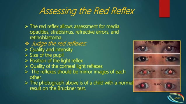 Bruckner test | PPTX | Eye and Vision Conditions | Diseases and Conditions