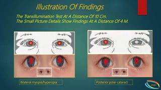 Red Reflex Ophthalmoscope