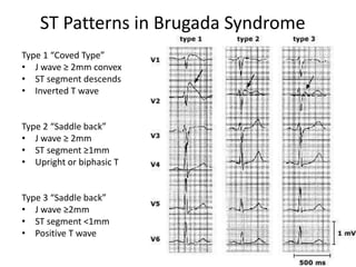 Brugada | PPTX