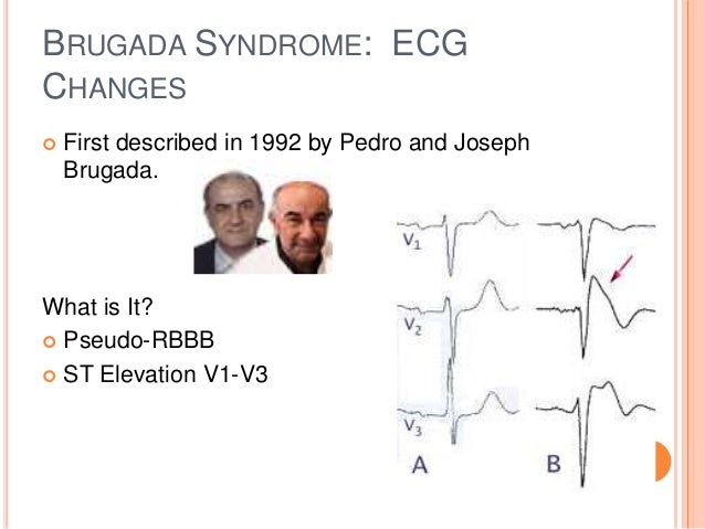 Brugada