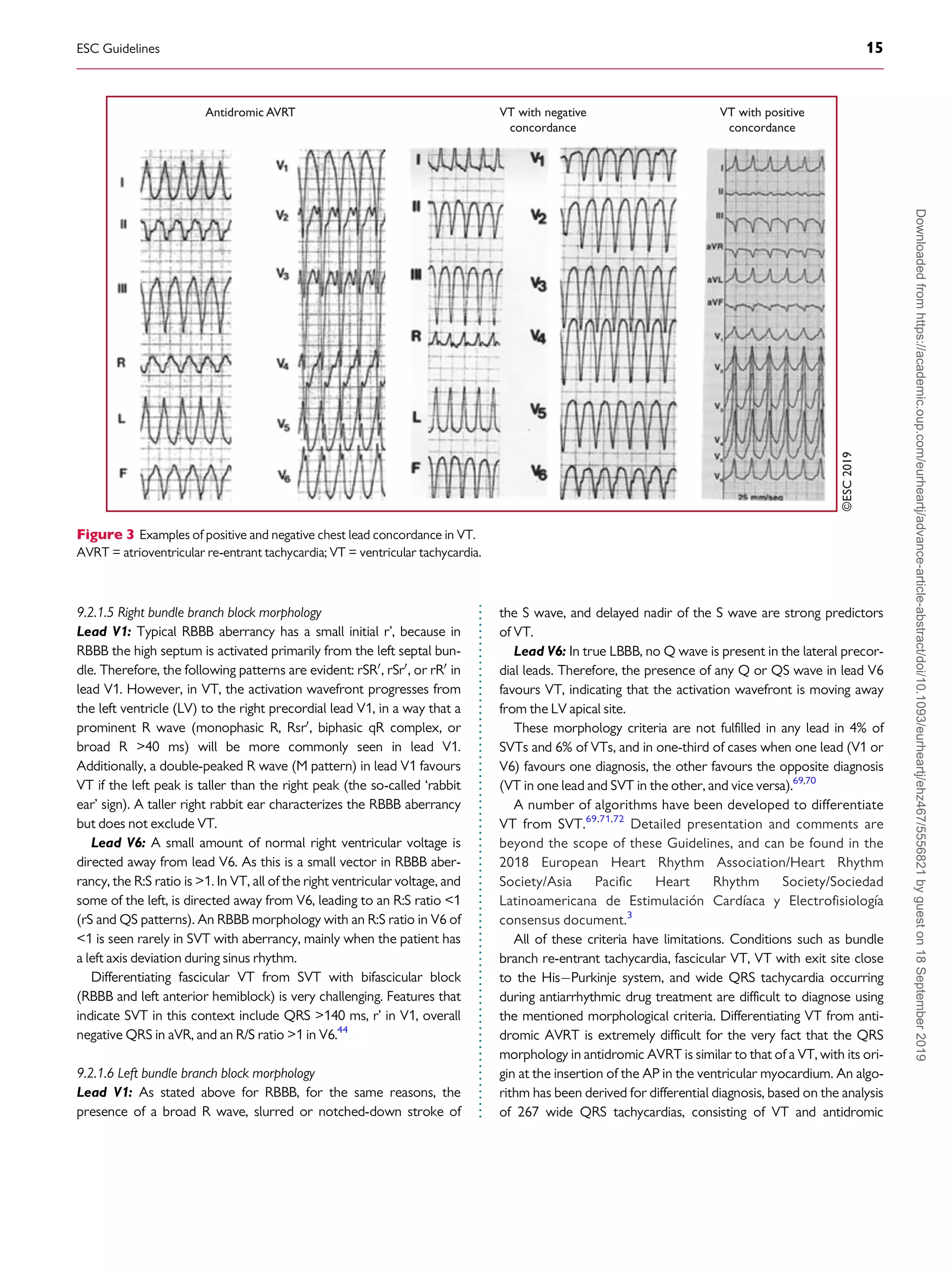Brugada 2020--esc-guidelines-for-the-management-supraventricular tachycardia -samir rafla | PDF