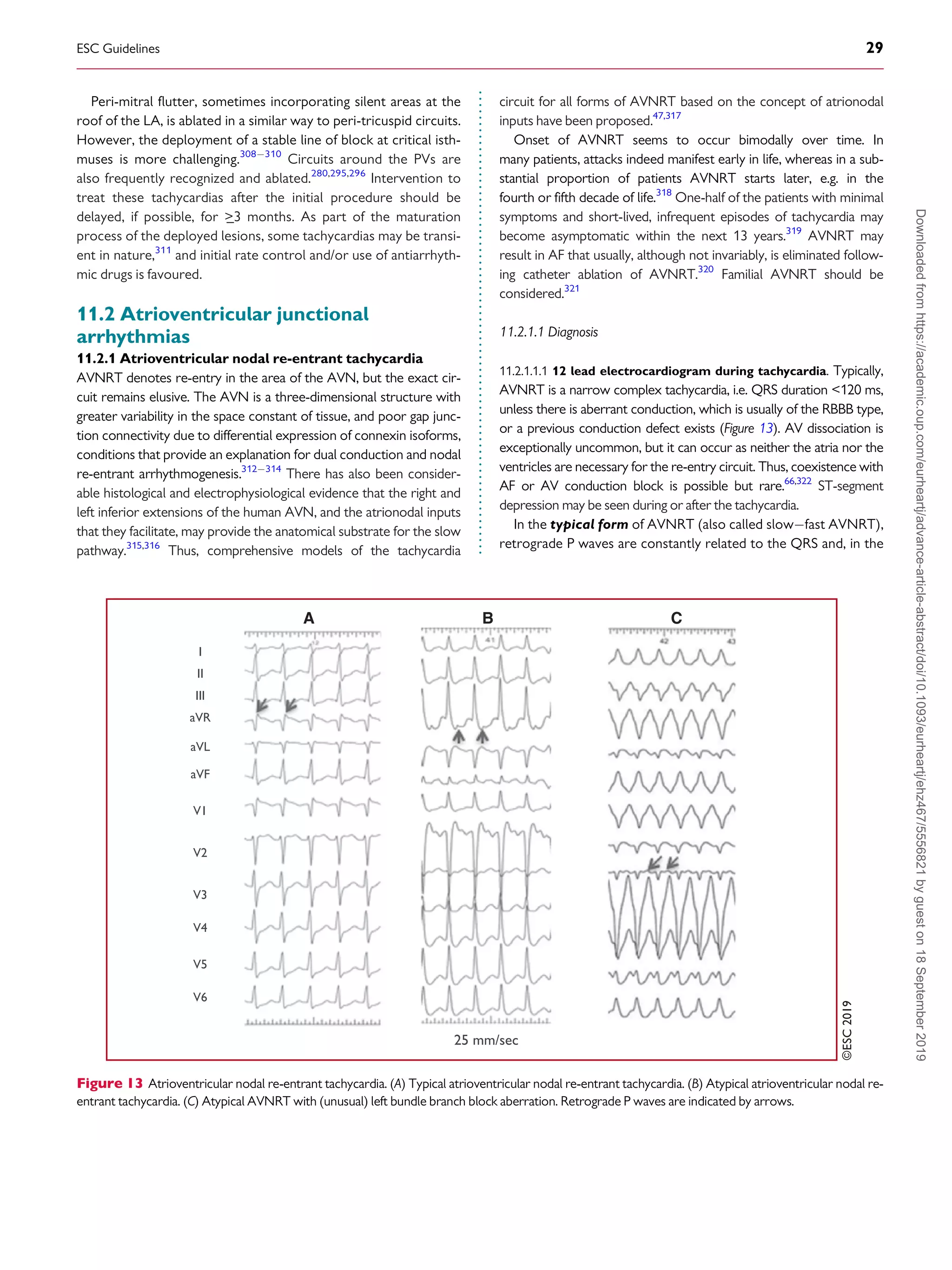 Brugada 2020--esc-guidelines-for-the-management-supraventricular tachycardia -samir rafla | PDF
