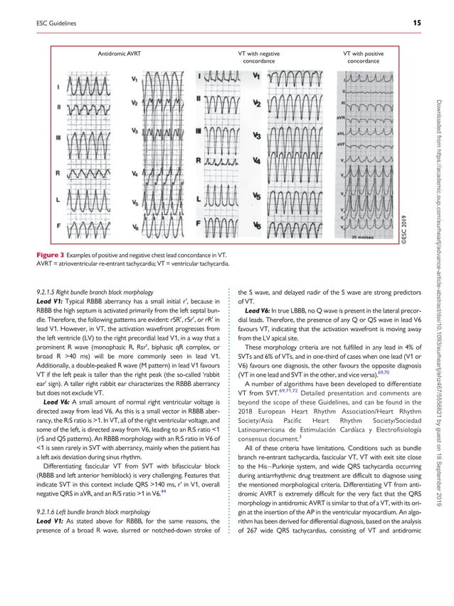 Brugada 2020--esc-guidelines-for-the-management-supraventricular ...