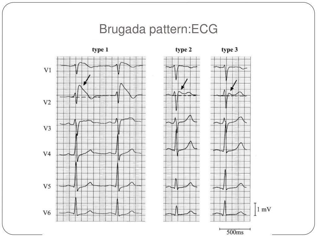 Brugada Syndrome by Abhishek Rathore MD DM