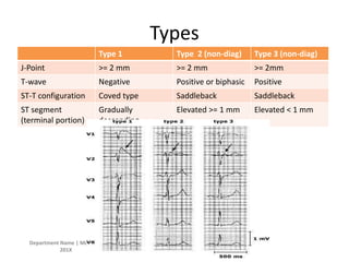 Brugada syndrome | PPTX