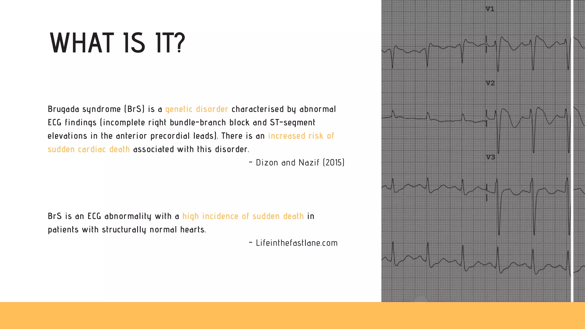 Brugada syndrome (BrS) | PDF