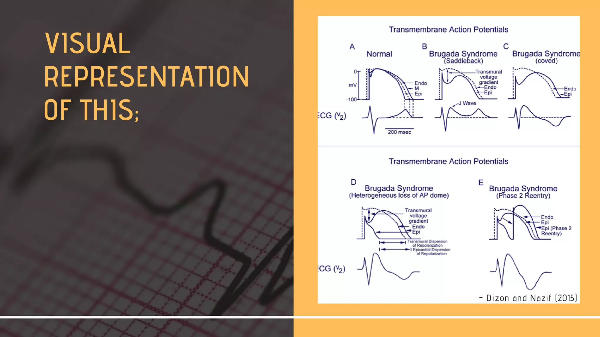 Brugada syndrome (BrS) | PDF