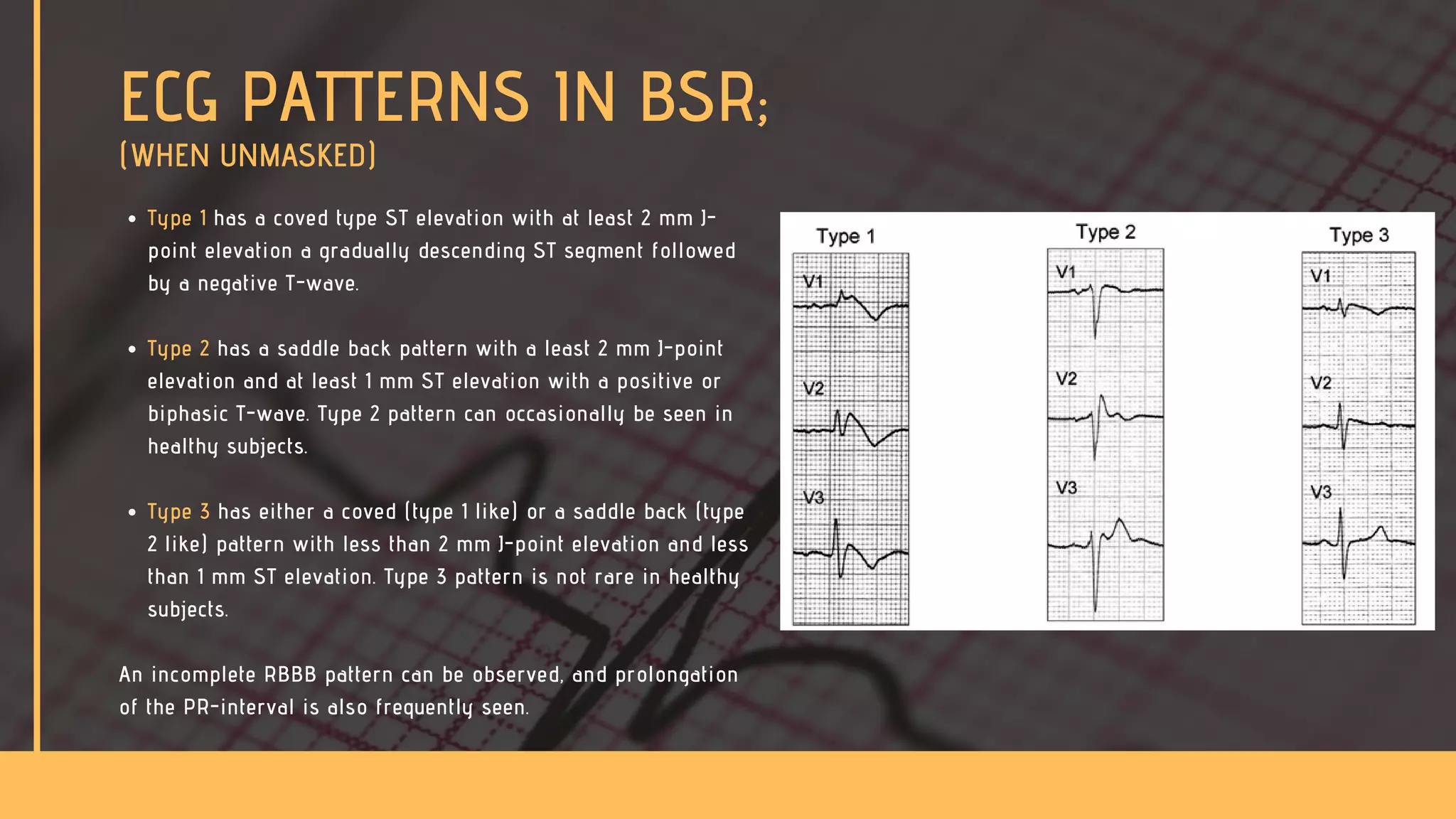Brugada syndrome (BrS) | PDF