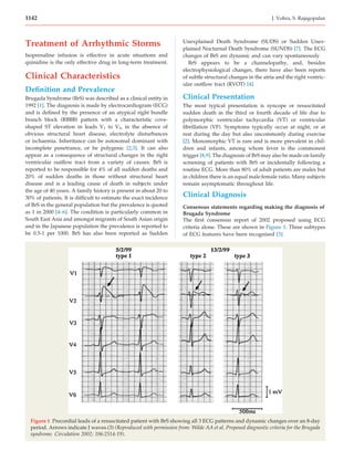 Brugada syndrome | PDF