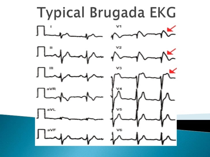 Brugada Syndrome