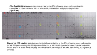 Brugada Syndrome in Pulmonary Embolism Extremely Rare Presentation.pptx