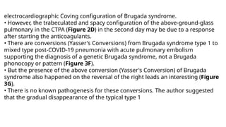 Brugada Syndrome in Pulmonary Embolism Extremely Rare Presentation.pptx