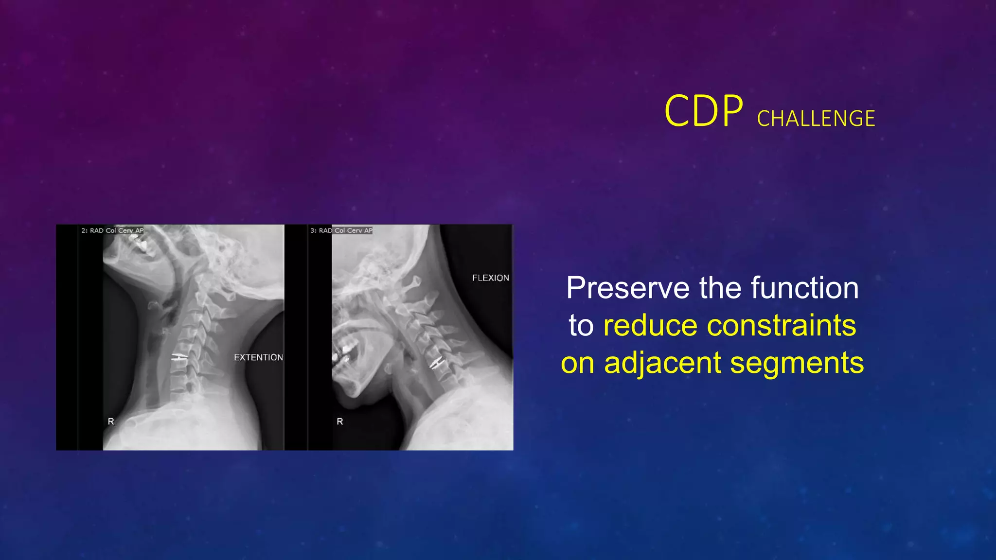 Cervical Fusion versus Cervical Disc Prosthesis | PPTX