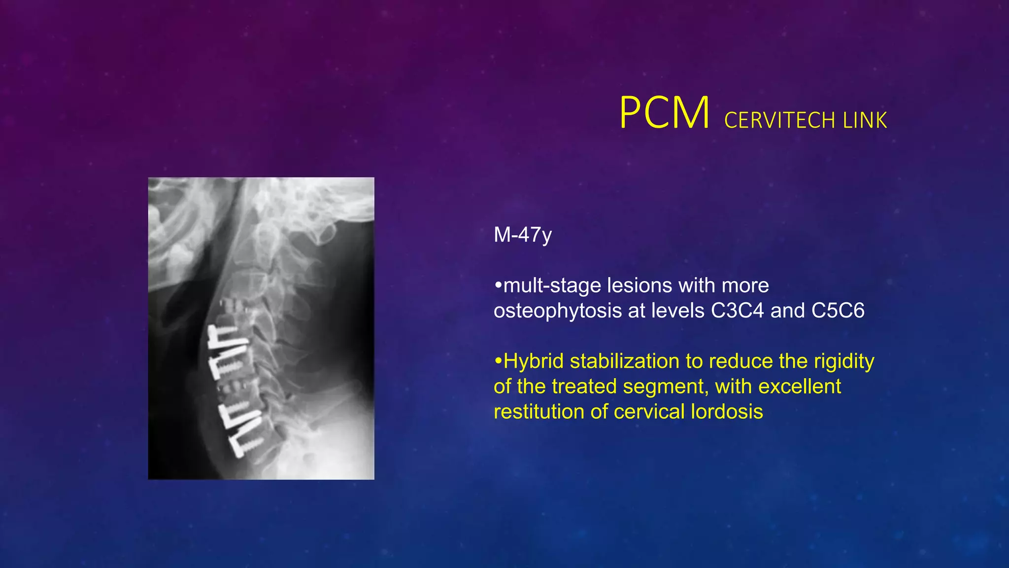 Cervical Fusion versus Cervical Disc Prosthesis | PPTX