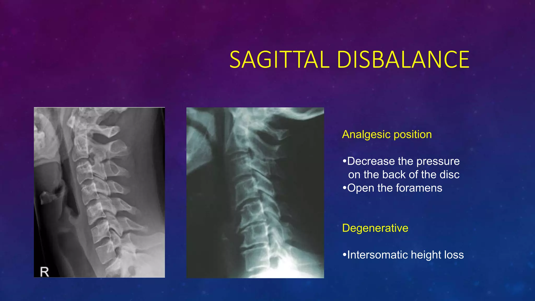 Cervical Fusion versus Cervical Disc Prosthesis | PPTX
